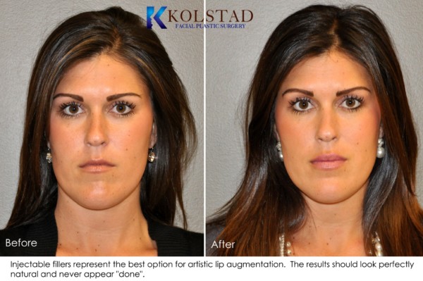 Natural & Artistic Lip Augmentation Before & After Photos | Dr. Kolstad ...