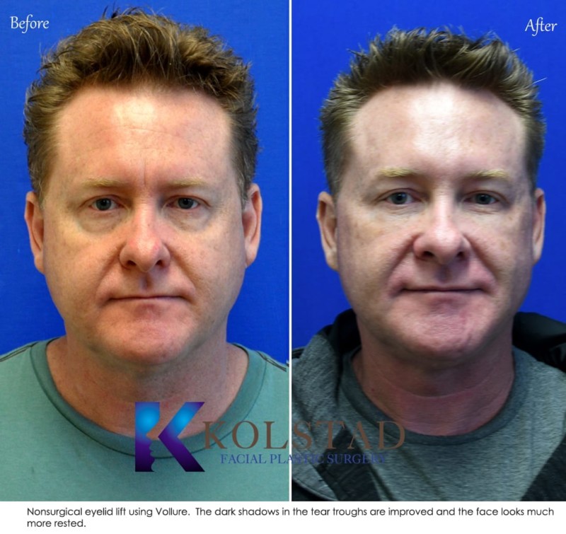Nonsurgical Eyelid Lift for Men | Dr. Kolstad - San Diego Facial ...