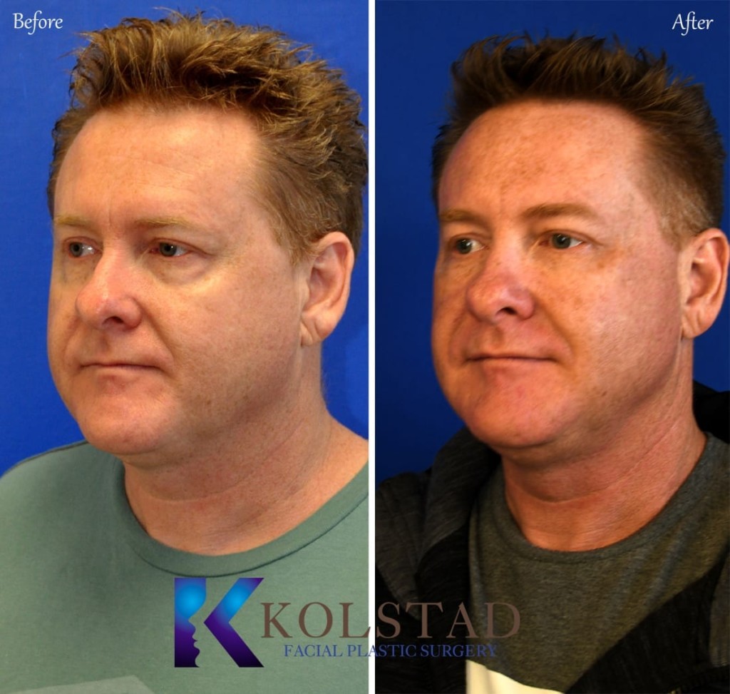 Nonsurgical Eyelid Lift for Men | Dr. Kolstad - San Diego Facial ...