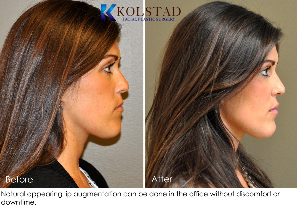 Natural & Artistic Lip Augmentation Before & After Photos | Dr. Kolstad ...