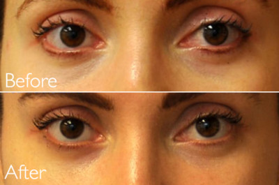 restylane-under-eye-filler-tear-trough-correction-expert-injector ...