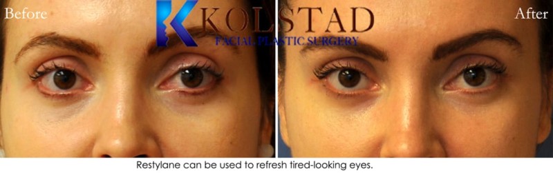Under Eye Tear Trough Filler Options | Dr. Kolstad - San Diego Facial ...