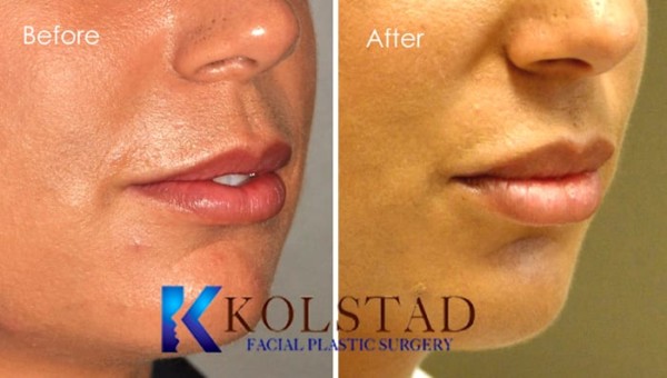 Lip Filler with Restylane | Dr. Kolstad - San Diego Facial Plastic Surgeon