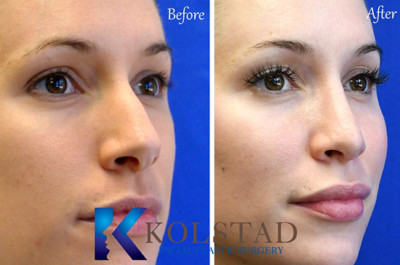 Drooping Columella Rhinoplasty | Dr. Kolstad - San Diego Facial Plastic ...