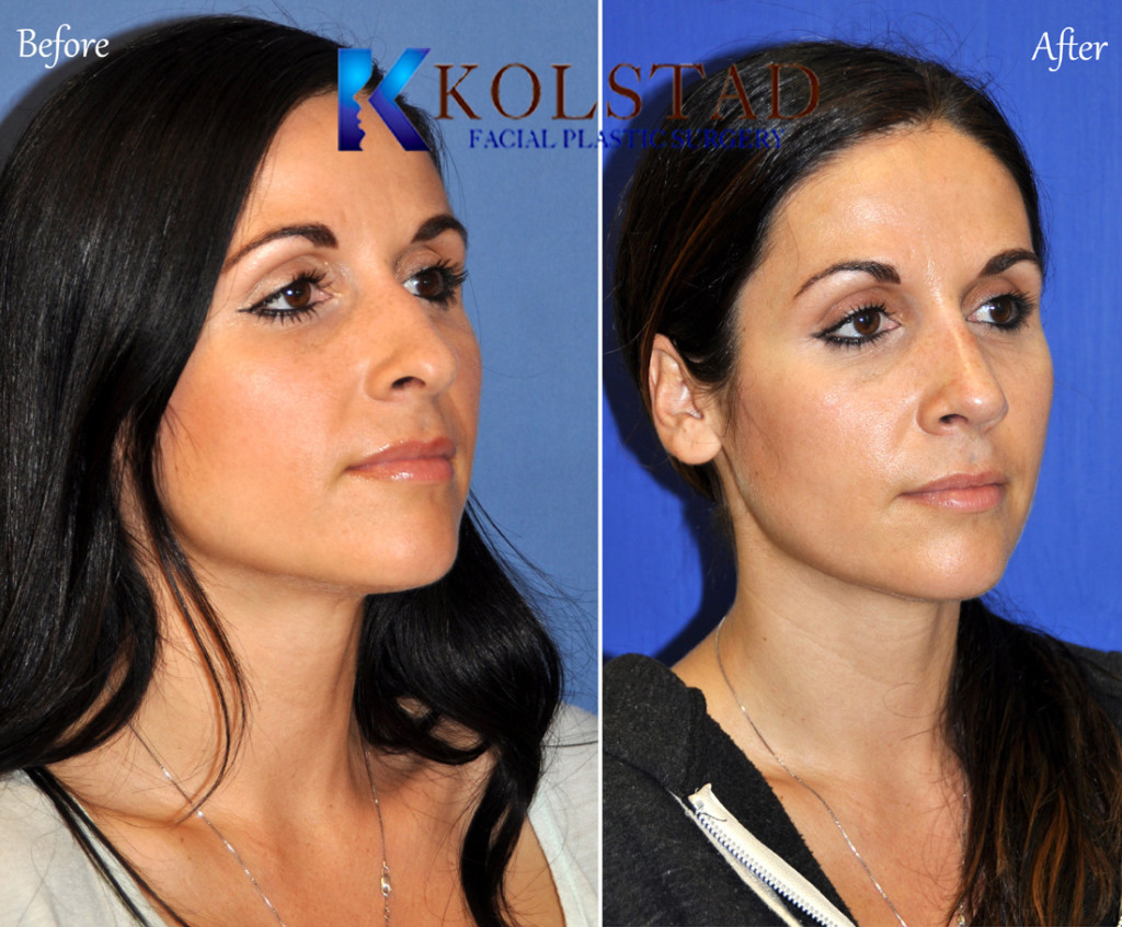 Columella Reshaping Nose Surgery San Diego Gallery 19 | Dr. Kolstad ...