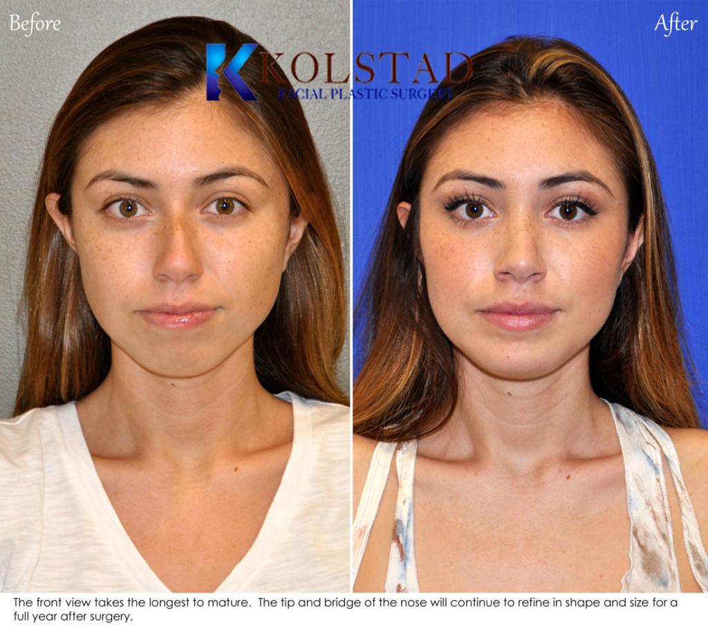 NOSE JOB WITH CHIN AUGMENTATION Gallery 1 | Dr. Kolstad - San Diego ...