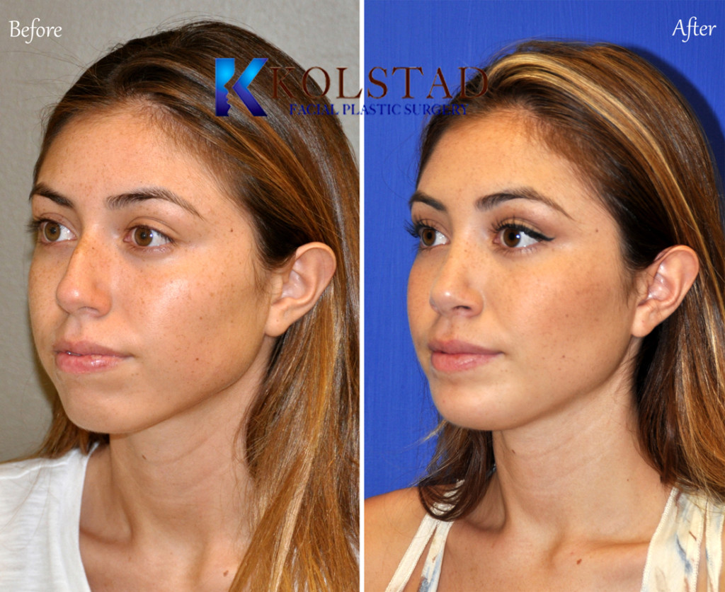 NOSE JOB WITH CHIN AUGMENTATION Gallery 1 | Dr. Kolstad - San Diego ...
