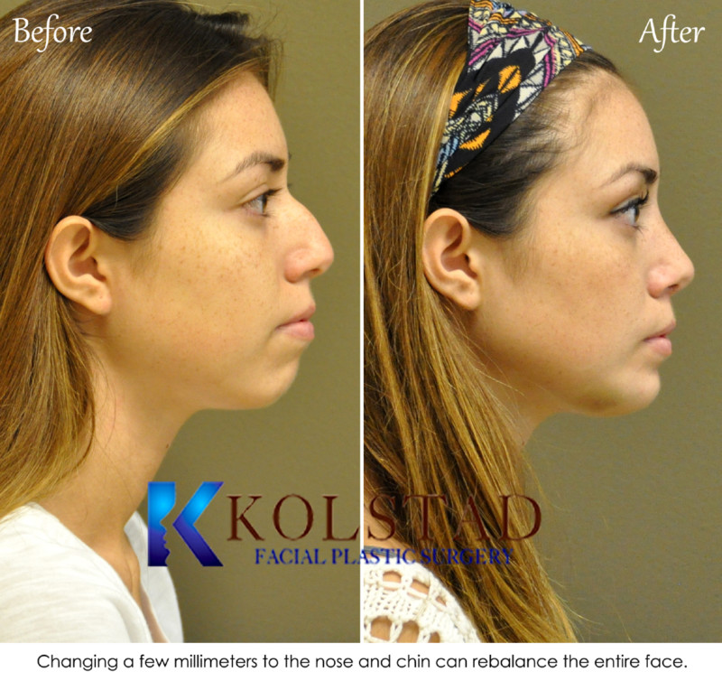 NOSE JOB WITH CHIN AUGMENTATION Gallery 1 | Dr. Kolstad - San Diego ...