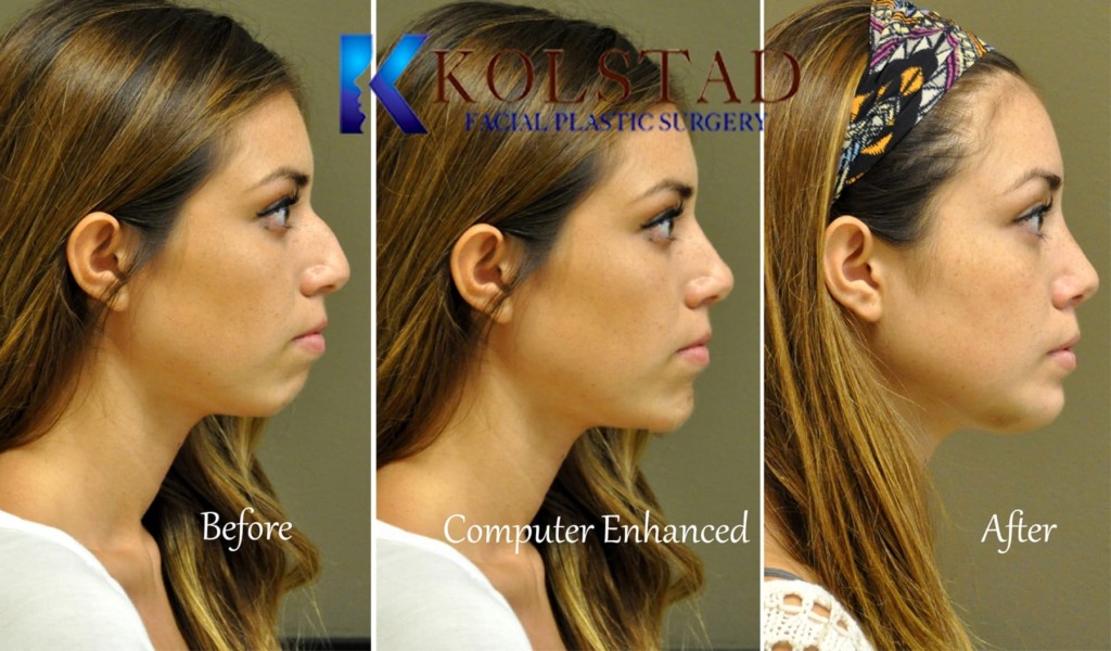 NOSE JOB WITH CHIN AUGMENTATION Gallery 1 | Dr. Kolstad - San Diego ...