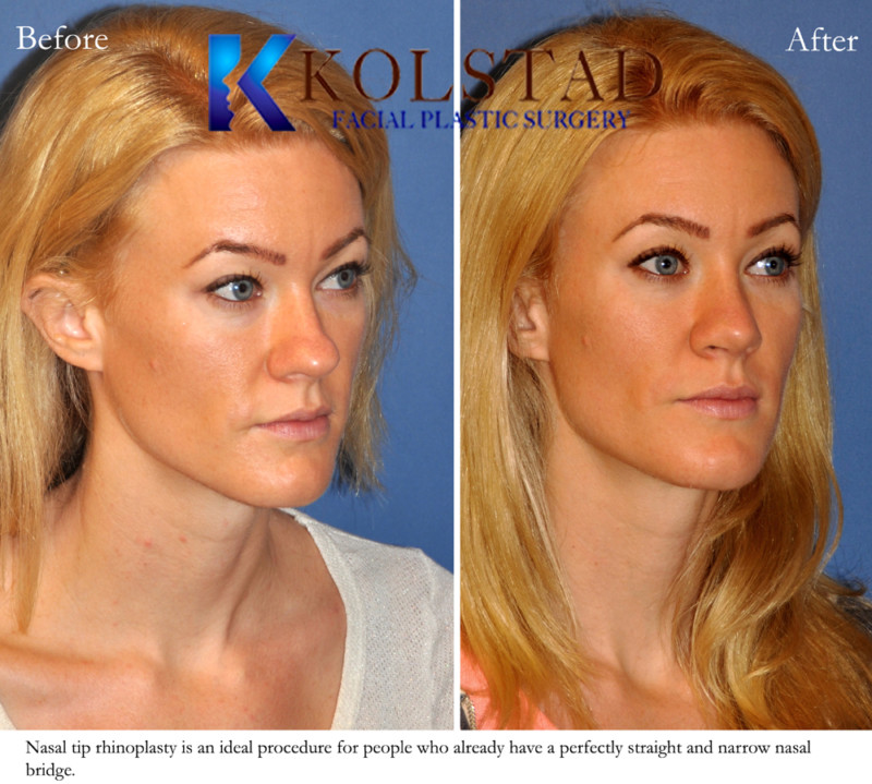 Bulbous Tip Rhinoplasty La Jolla Before & After Gallery 1 | Dr. Kolstad ...