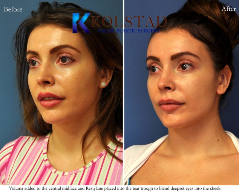 Voluma Specials for Central Cheek Volume Restoration | Dr. Kolstad ...