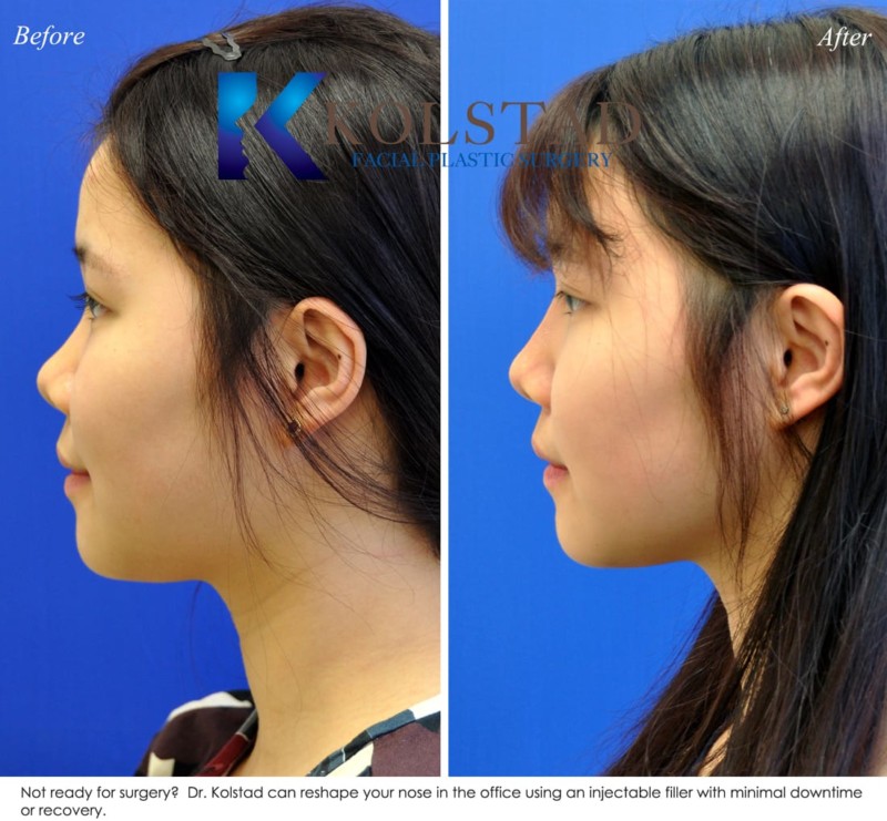 Non Surgical Asian Rhinoplasty San Diego Before & After Gallery 1 | Dr. Kolstad - San Diego ...