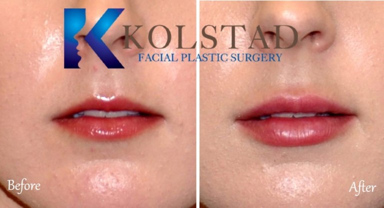 best-lip-augmentation-san-diego-la-jolla-del-mar-top-filler-expert ...