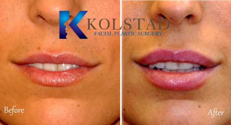 lip-filler-natural-augmentation-enhancement-fuller-lips-san-diego-la ...