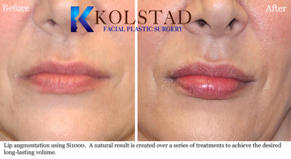 Beautiful and Natural Permanent Lip Augmentation | Dr. Kolstad - San ...