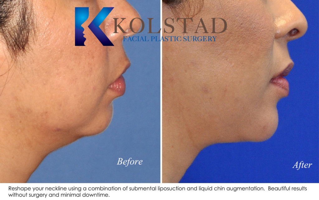 Submental Liposuction with Liquid Chin | Dr. Kolstad - San Diego Facial ...