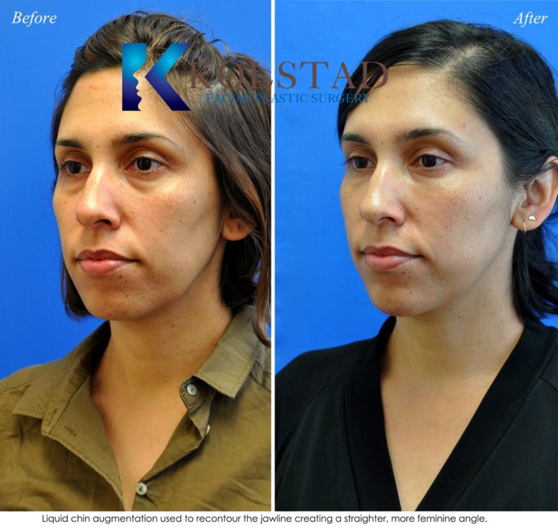 La Jolla Non Surgical Chin Augmentation & Jawline Augmentation Before ...