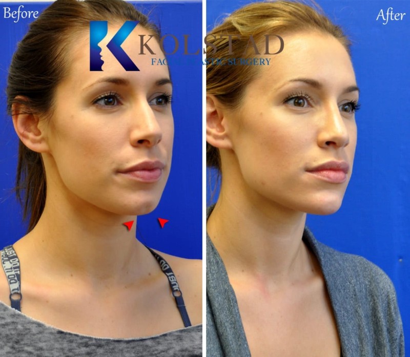 Liquid Chin Augmentation to Correct Chin Dimple | Dr. Kolstad - San ...
