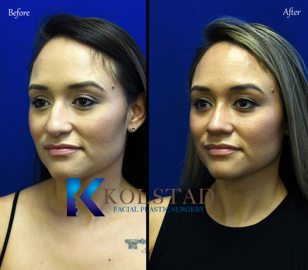 Droopy nose before and after | Dr. Kolstad - San Diego Facial Plastic ...