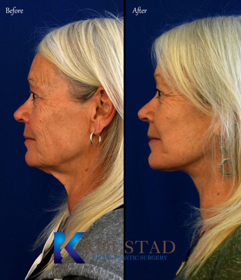 Facelift Before & After Gallery 16 | Dr. Kolstad - San Diego Facial ...