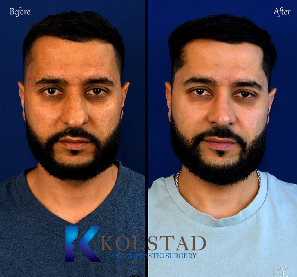 best nose job san diego | Dr. Kolstad - San Diego Facial Plastic Surgeon