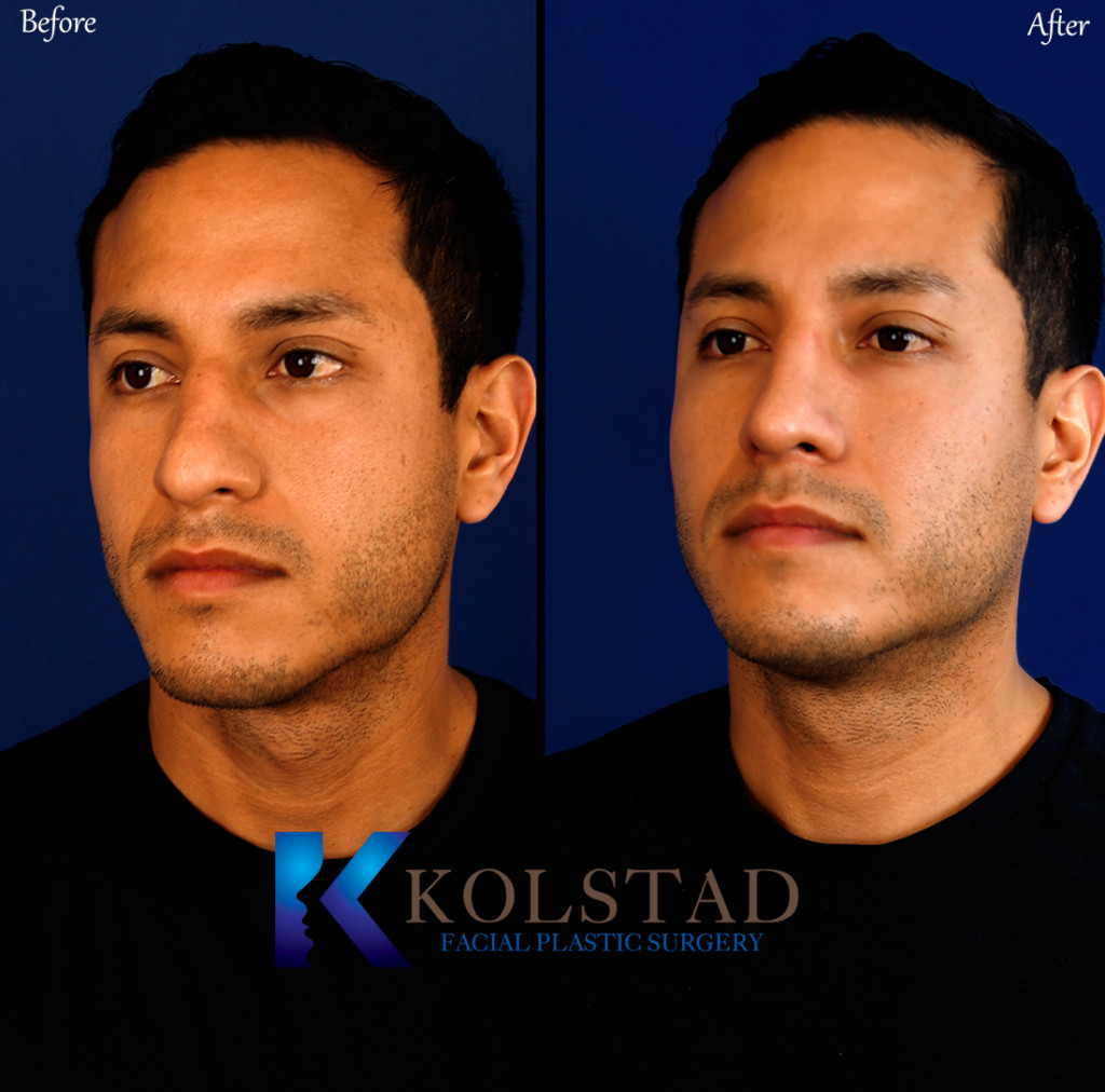 Hispanic Rhinoplasty San Diego | Dr. Kolstad - San Diego Facial Plastic ...