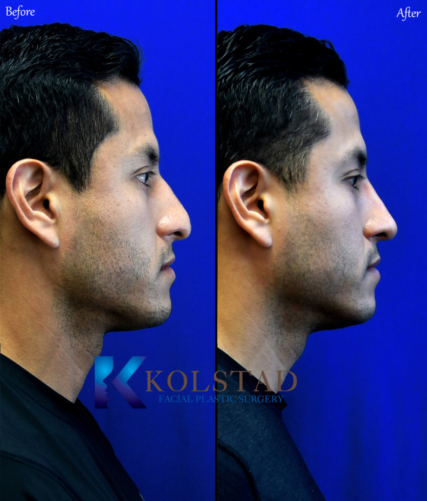 Hispanic Rhinoplasty San Diego | Dr. Kolstad - San Diego Facial Plastic ...