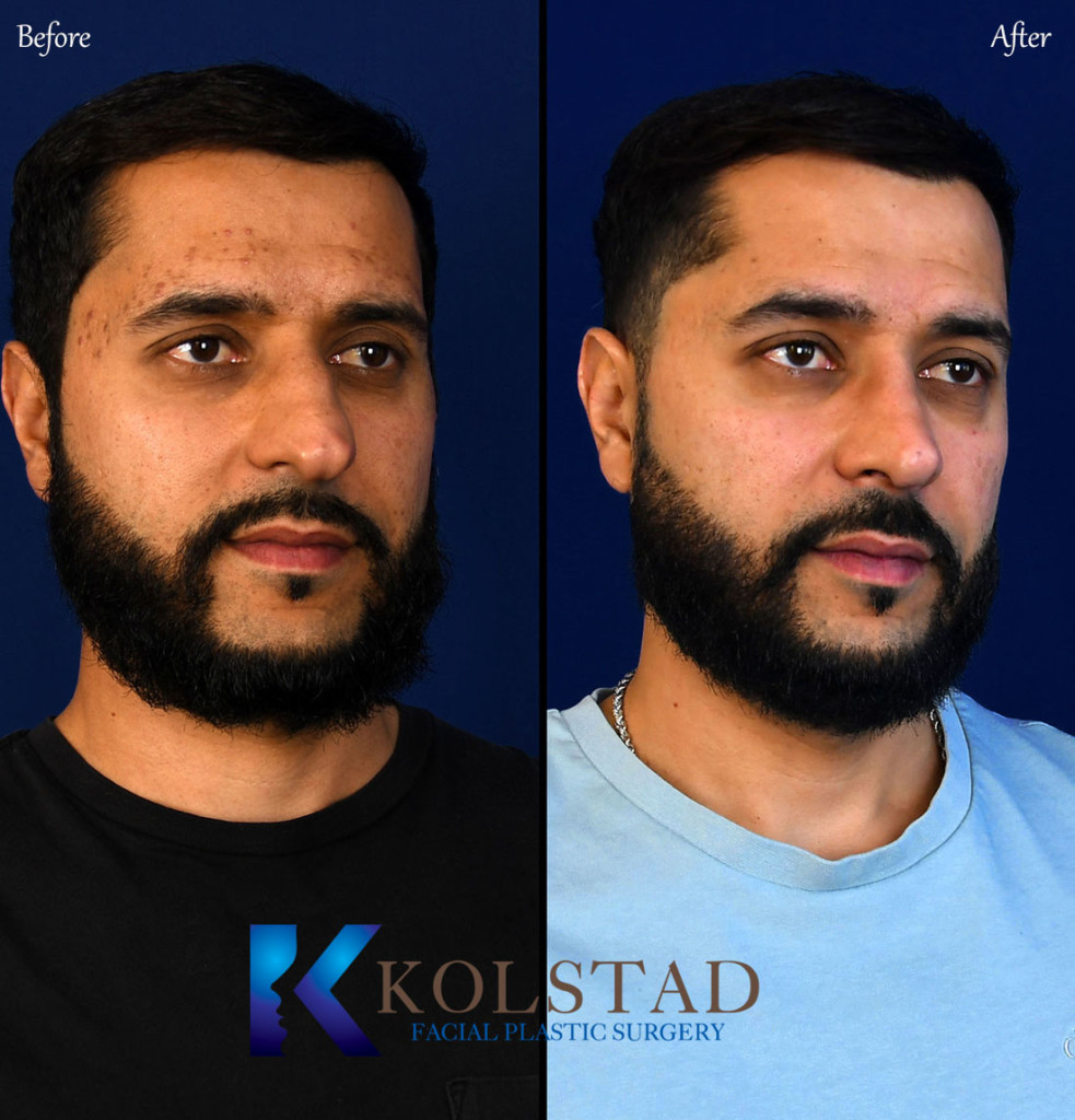 best nose job san diego | Dr. Kolstad - San Diego Facial Plastic Surgeon