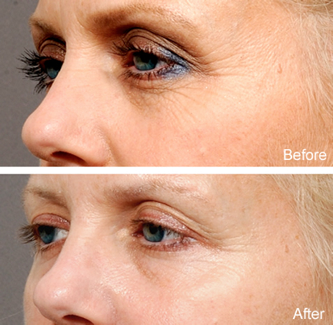 The Eyelid Aging Process: What Can I Do Besides Surgery? | Dr. Kolstad ...